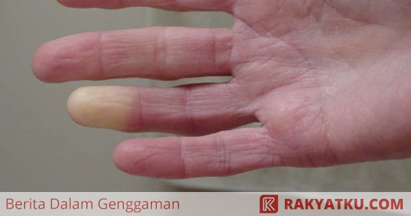 Cek Sekarang! 6 Penyakit Terbaca dari Tangan, Mulai Covid-19 Hingga ...